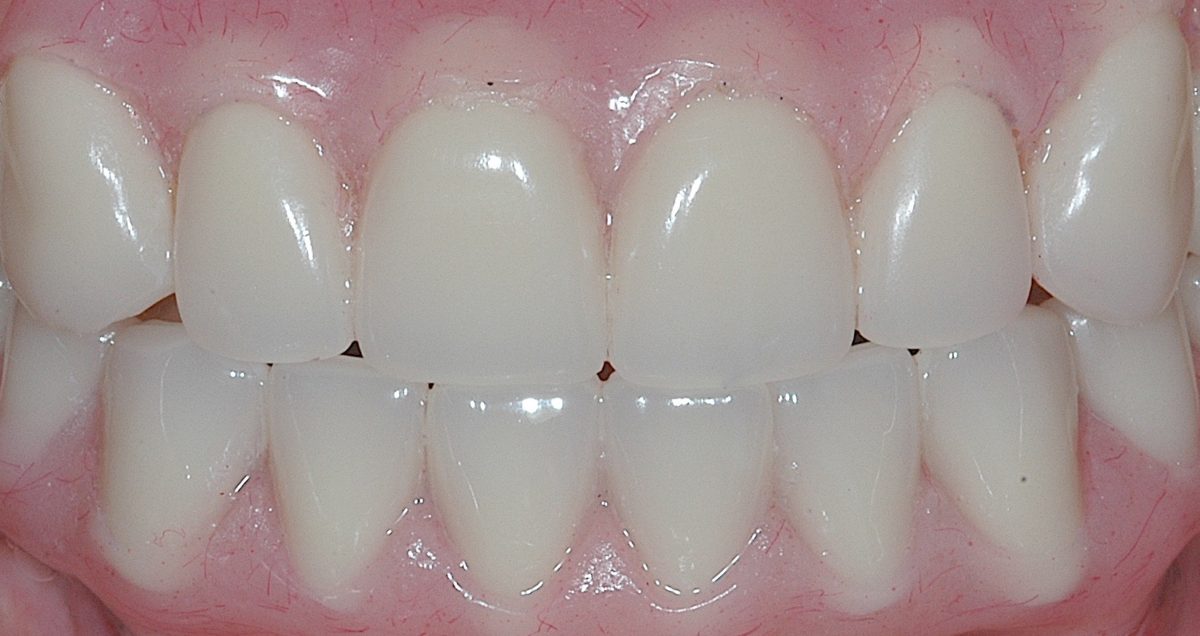 All-on-4 Dental Implants | Tamer Azim, DDS